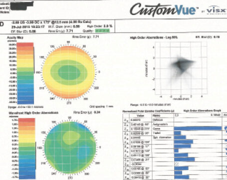 Understanding Astigmatism: High Numbers and Severity