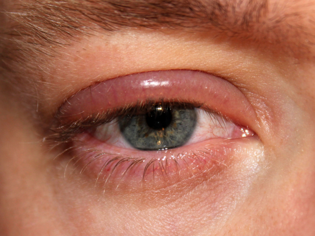 Understanding Sleepy Eye Syndrome and Its Symptoms